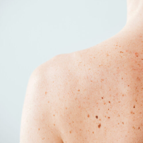 Tratamiento de lesiones pigmentadas - Clínica Bonome